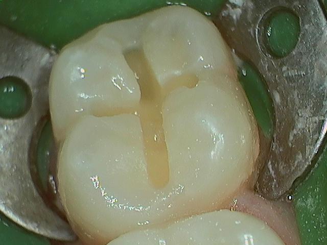Fillings & Bonding - Michael J. Maser, DMD, MAGD | Myrtle Beach, SC ...